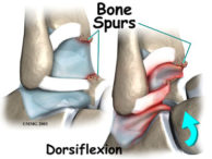 Ankle Bone Spurs, Aka Footballer’s Ankles | OrthofootMD