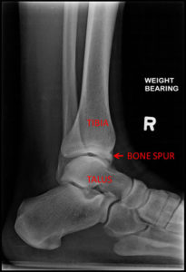 Ankle Bone Spurs, Aka Footballer’s Ankles | OrthofootMD