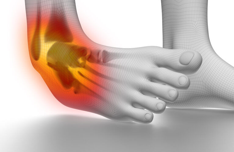 Sprained vs Fractured Ankle: What's the Difference?