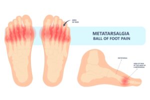 Metatarsalgia Pain Specialist | Surgery in Singapore
